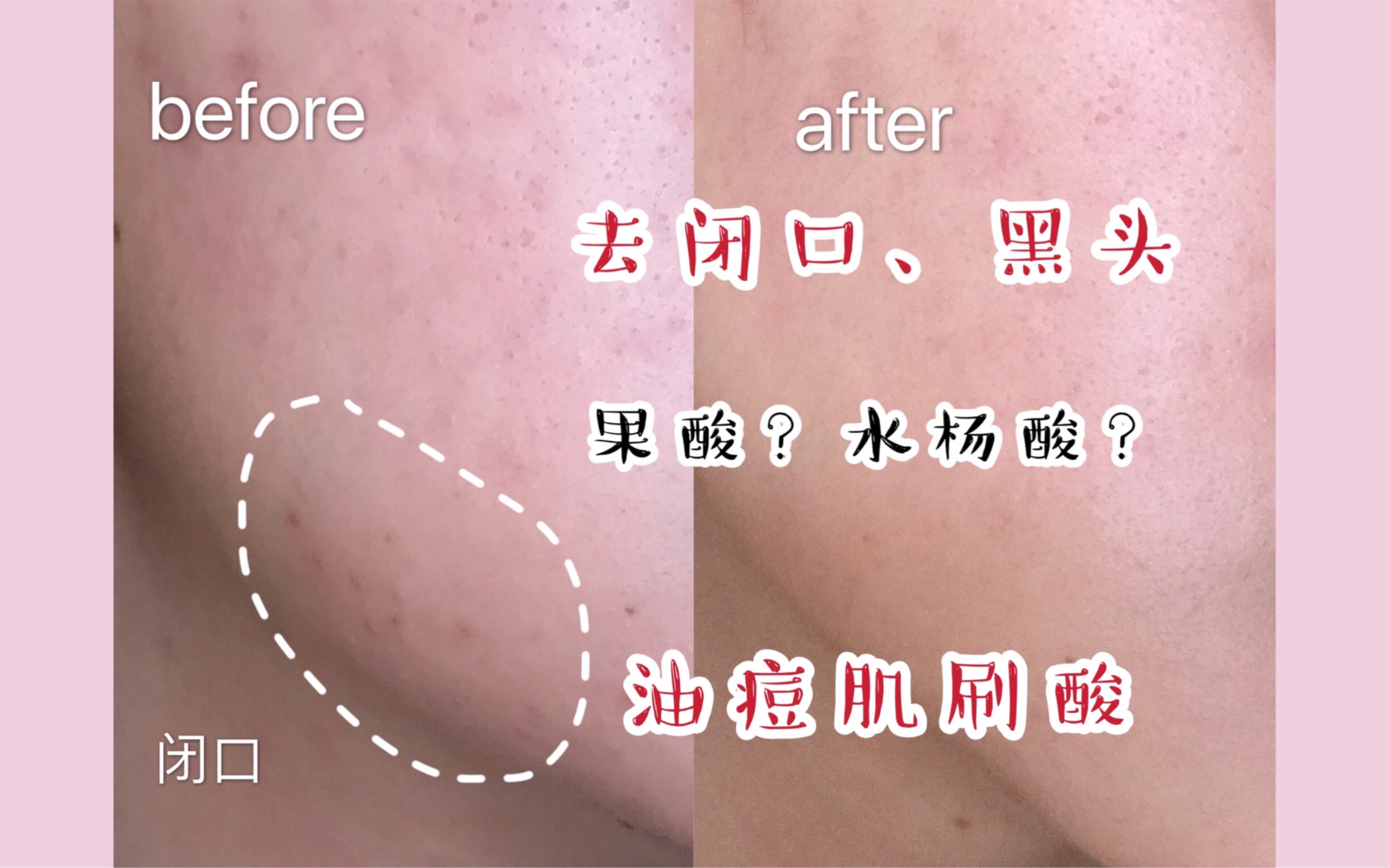 闭口、黑头!油痘肌刷酸功课|果酸、水杨酸怎么用?