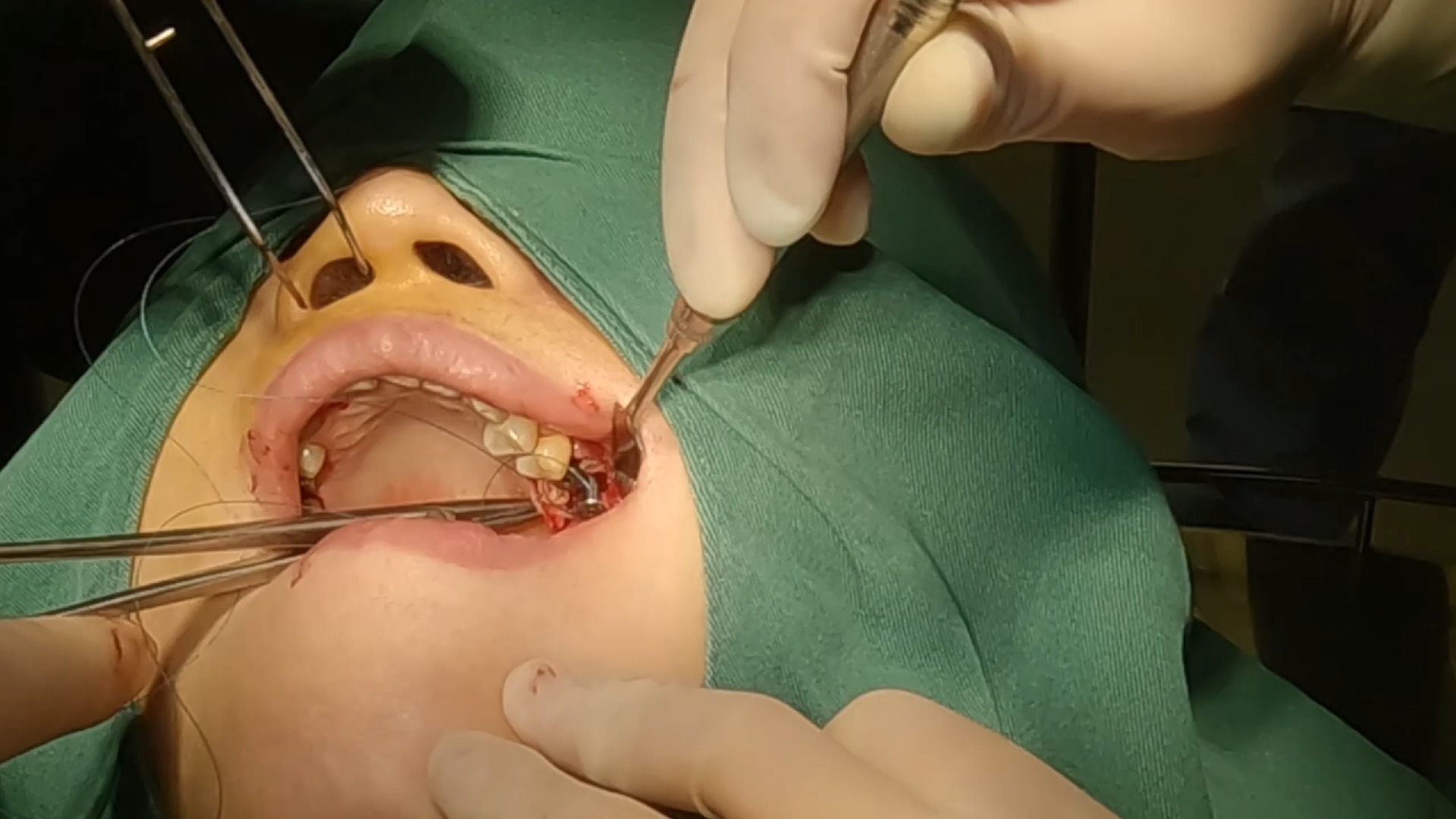 即刻种植同期上颌窦提升术实况