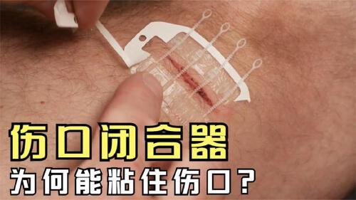 伤口“闭合器”是什么?外观酷似拉链,为何用它能粘住伤口?