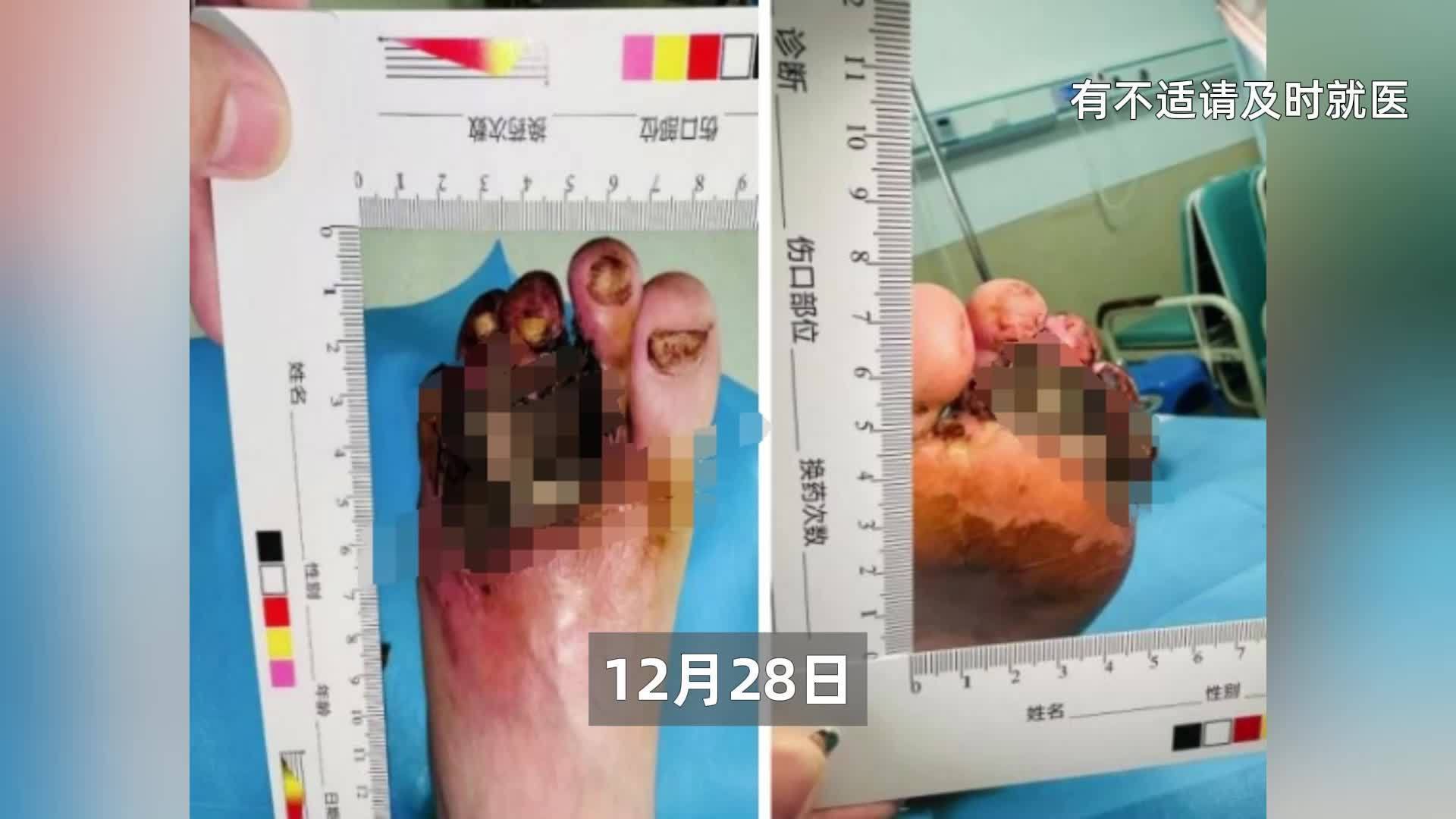 男子得足癣用偏方治7个月,发烂发臭脚趾险保不住,向头皮借皮移植