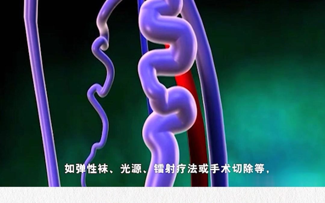 下肢动画科普之什么是静脉曲张?哈市下肢静脉曲张