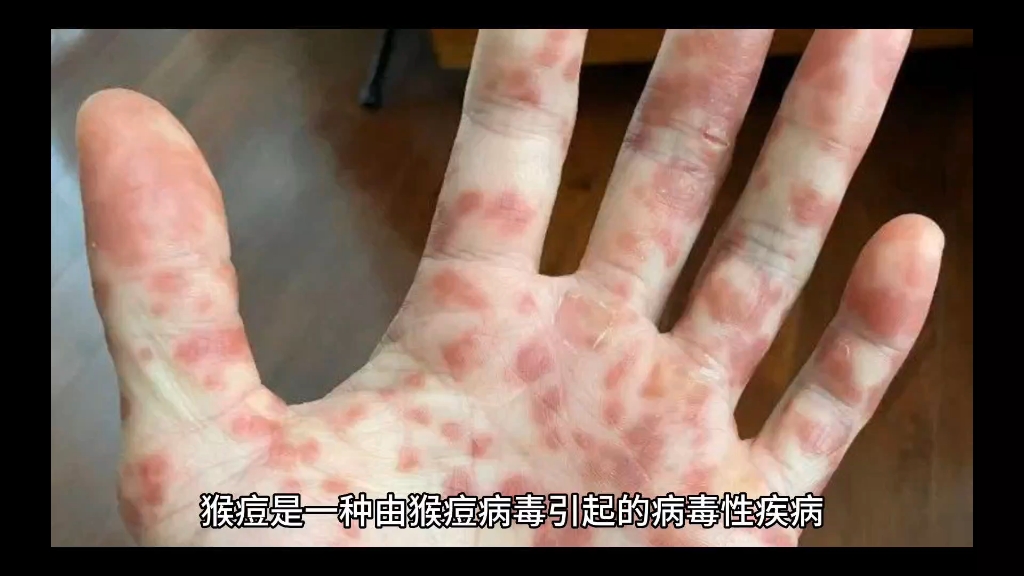 猴痘是什么?与天花,水痘,相似但不同。