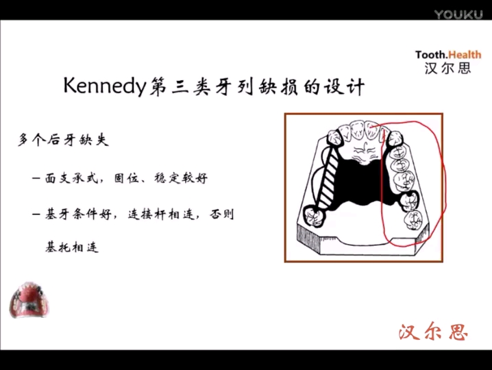 可摘局部义齿的设计