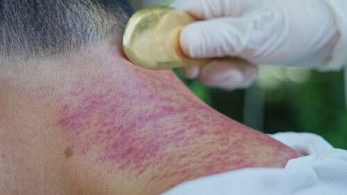 刮痧别乱来!女性后背过度刮痧的三大隐患,看完惊出一身冷汗