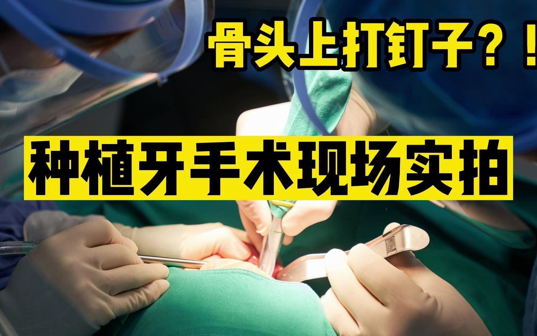 揭秘种植牙手术全过程!零距离直击种牙现场
