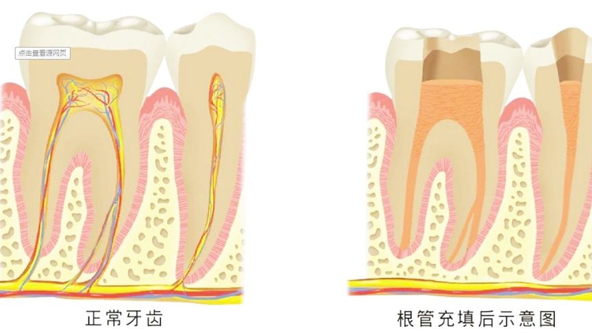 牙科医生必学知识,根管治疗详细讲解,经典案例解析