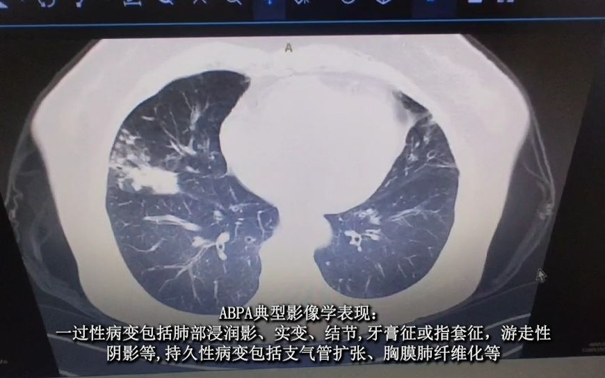 变应性支气管肺曲霉病(ABPA)