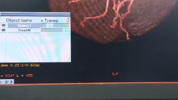 心脏冠状动脉,心梗就是这些血管某根堵了