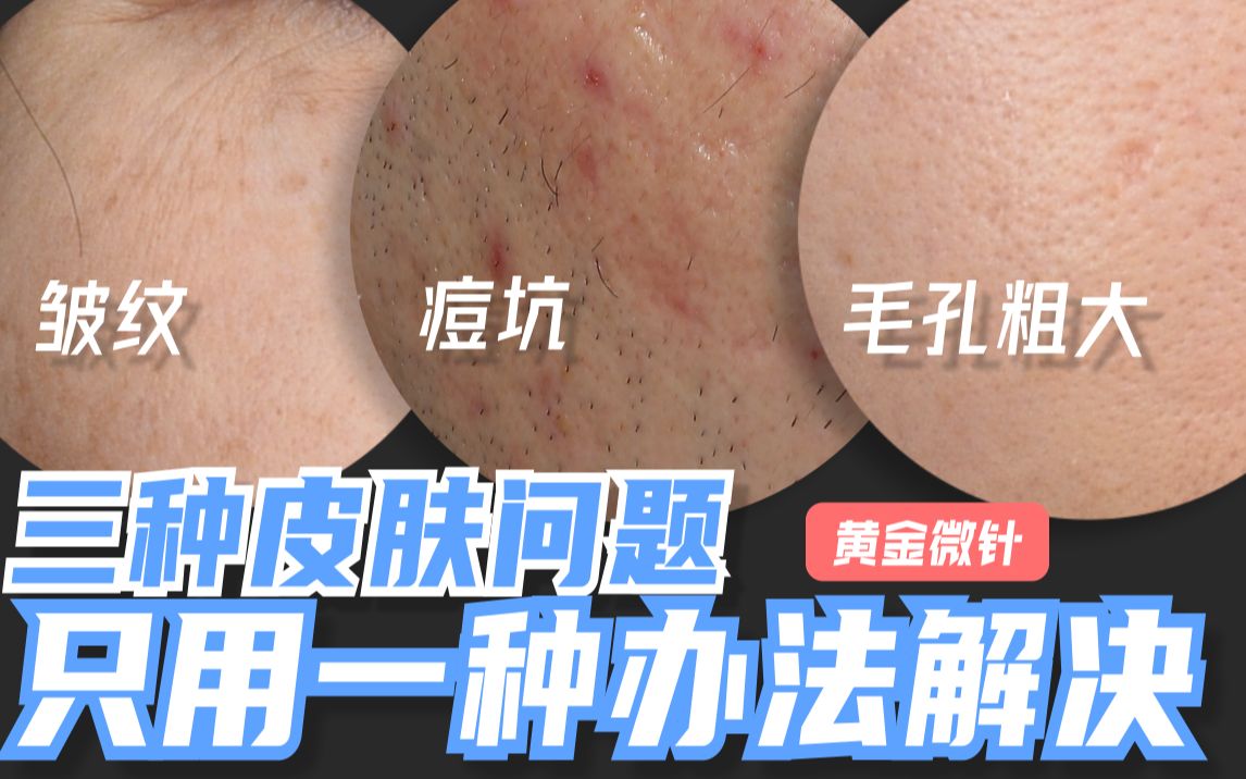 【痘坑福音】这效果简直绝了！黄金微针三种案例解析！