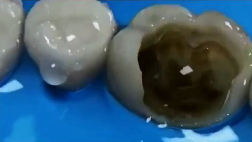 根管治疗过程原来是这样!