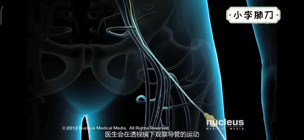 心脏冠状动脉造影术手术过程,3D演示。