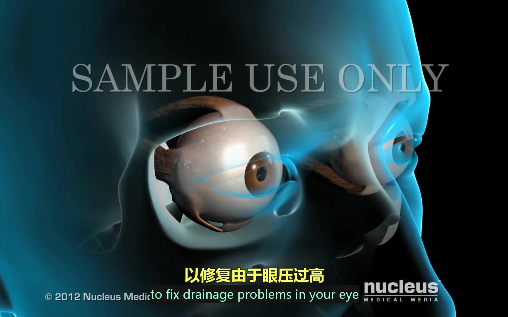 【3D医学动画】青光眼(中英双字幕)