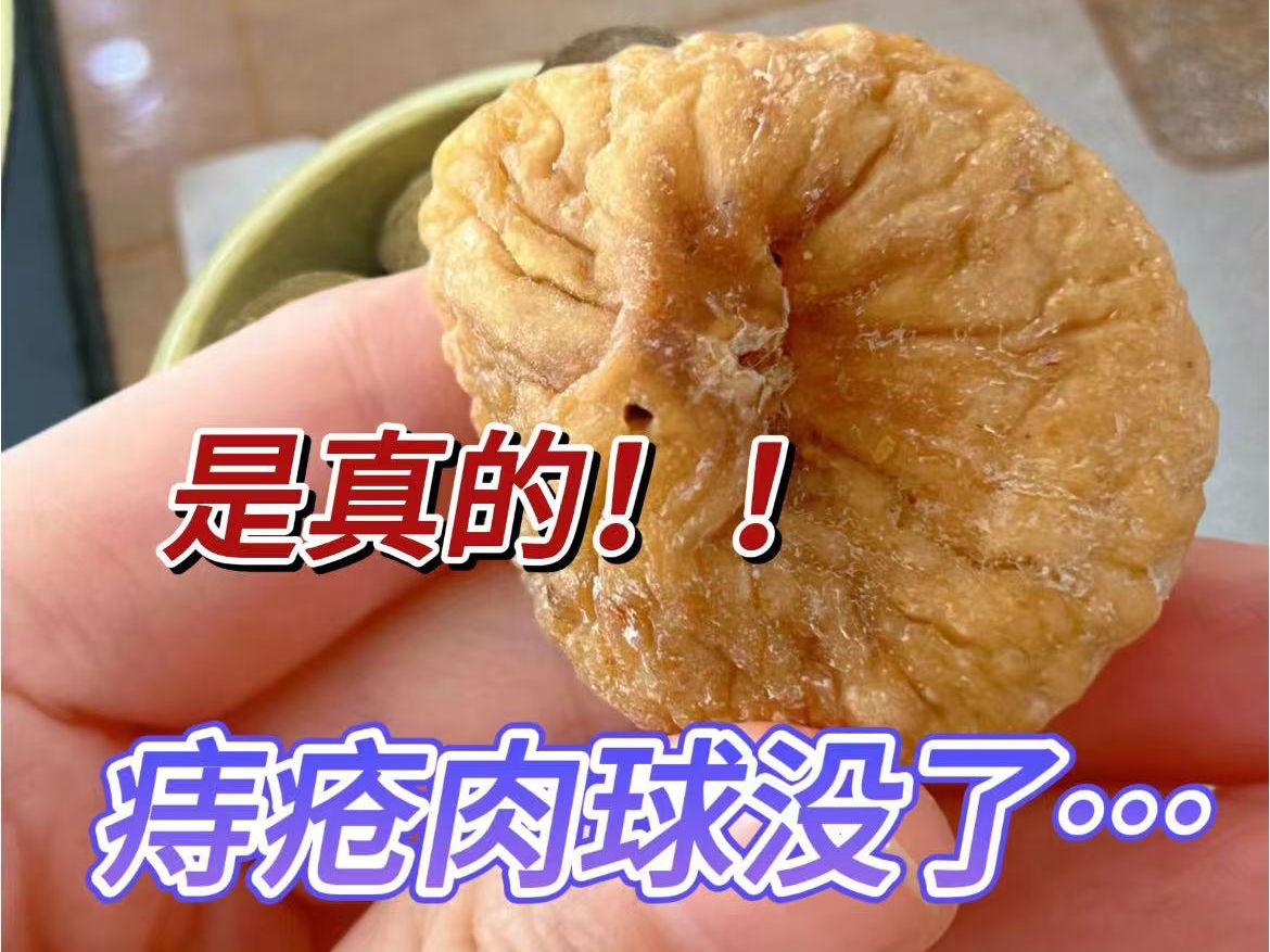 痔疮肉球红肿、总是便秘便血?简单3招,快速祛痔不再反复!