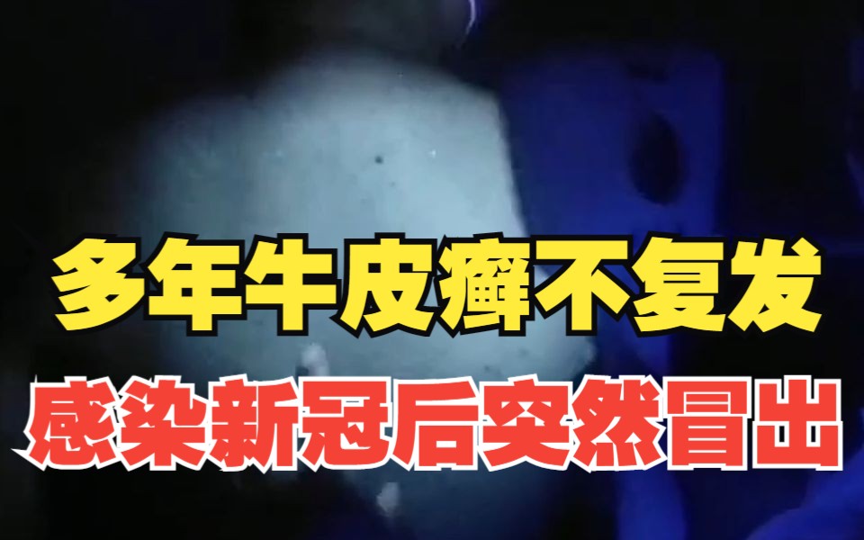 男子牛皮癣多年不复发,感染新冠后