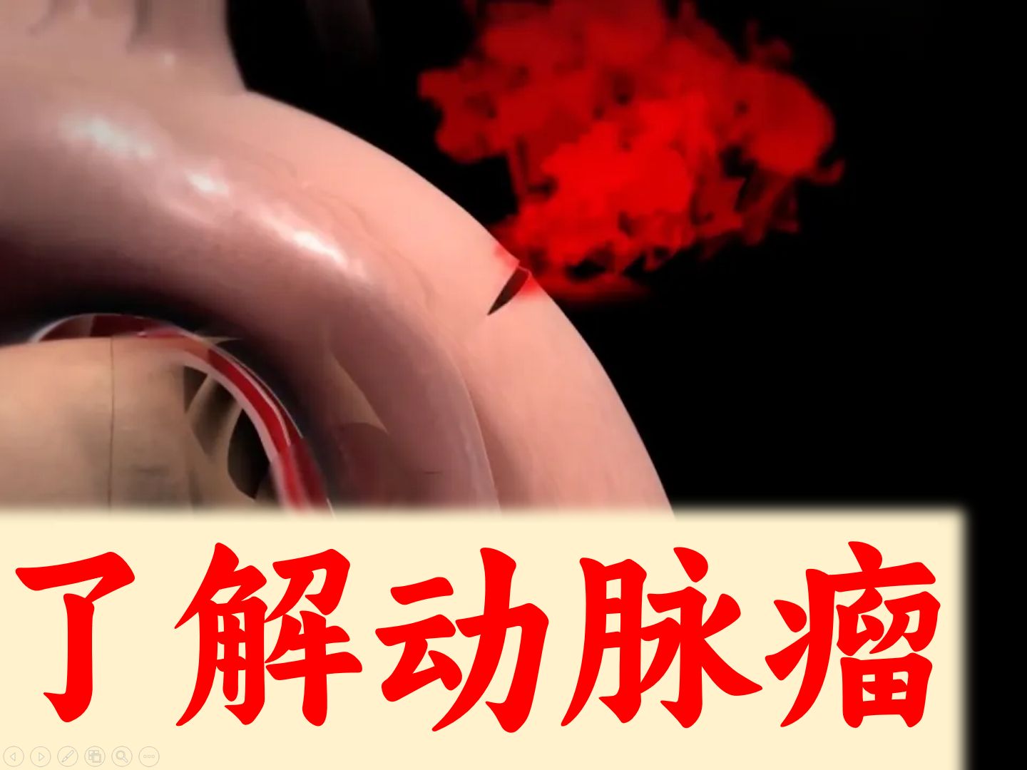 什么是主动脉瘤?【3D动画讲解】