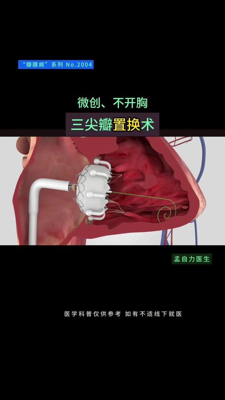 心脏"三尖瓣"也可以微创"不开刀"瓣膜置换#心脏瓣膜 #瓣膜置换...