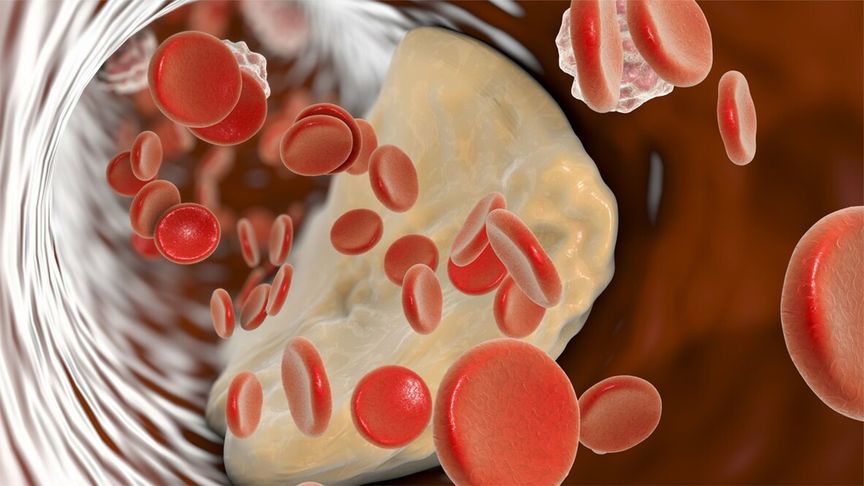 脑动脉粥样硬化不治疗会怎样?医生:或损害血管壁,诱发脑血栓