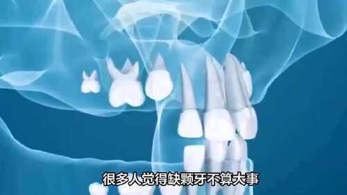 种植牙全过程曝光!医生不会告诉你的5大风险,看完再决定!