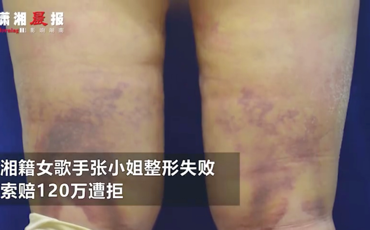 湖南籍女歌手张美美整形失败,深圳鹏爱医疗美容医院承认问题,一再让...