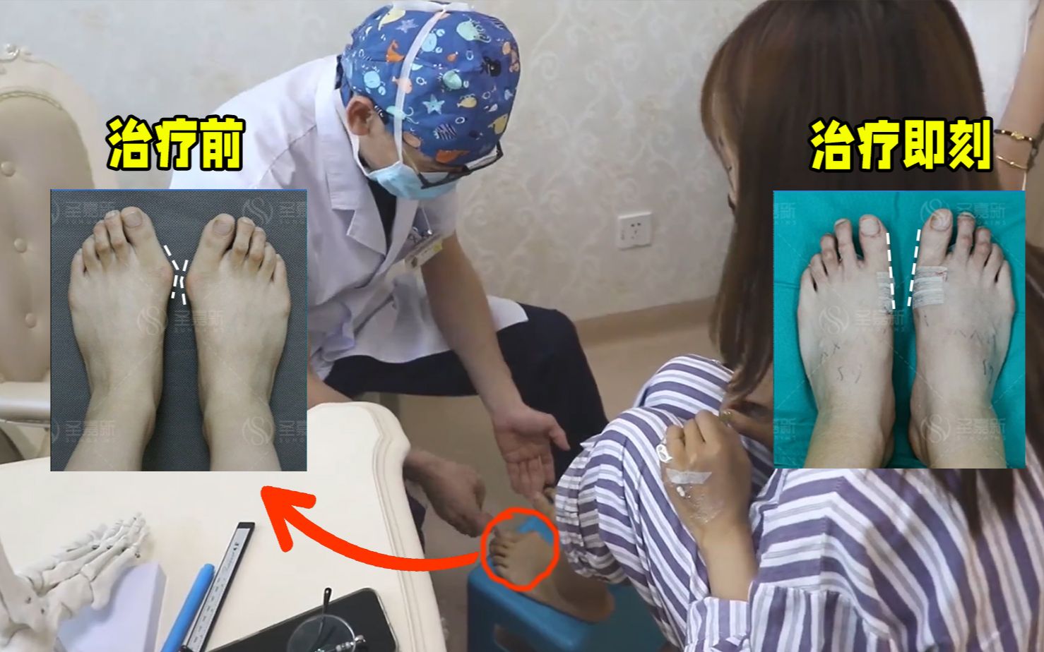 花1w大洋做大脚骨拇外翻手术后不后悔?效果真香