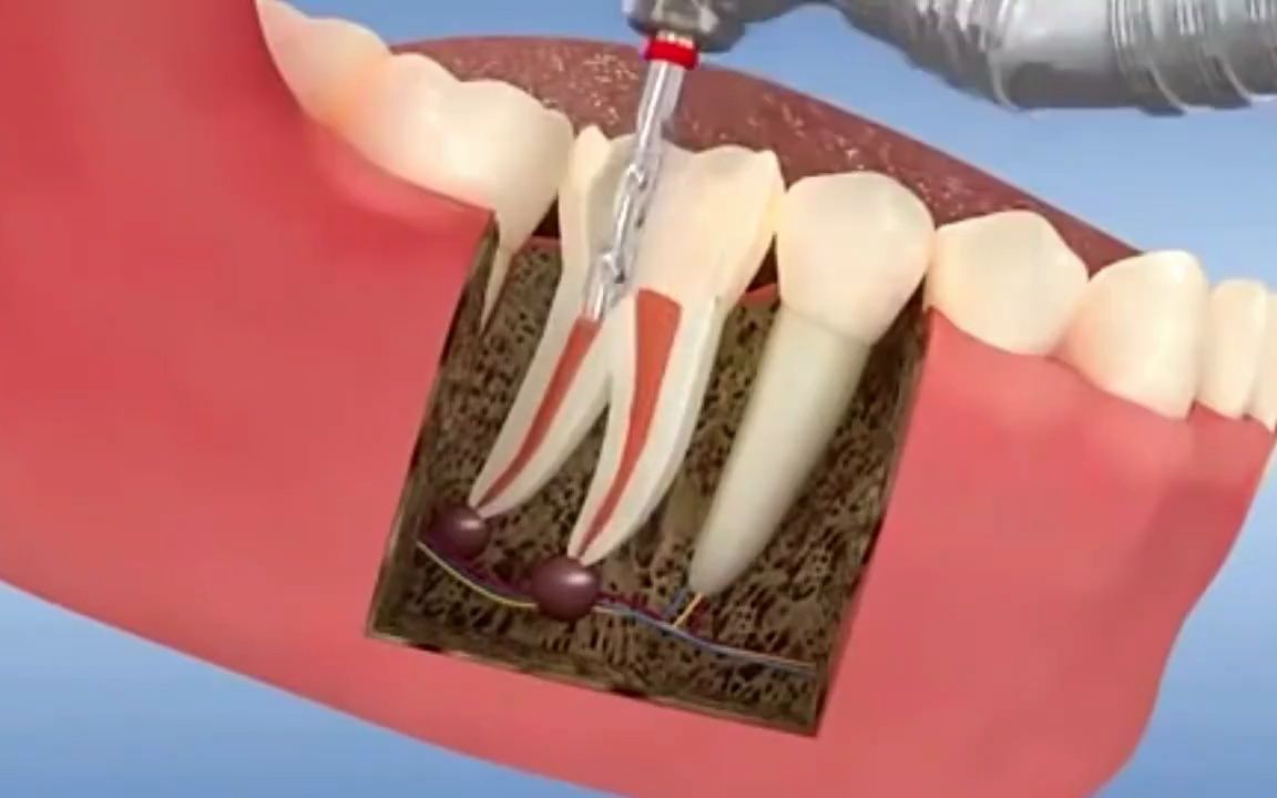 济宁玉红口腔 | 3D动画演示:牙齿根管治疗