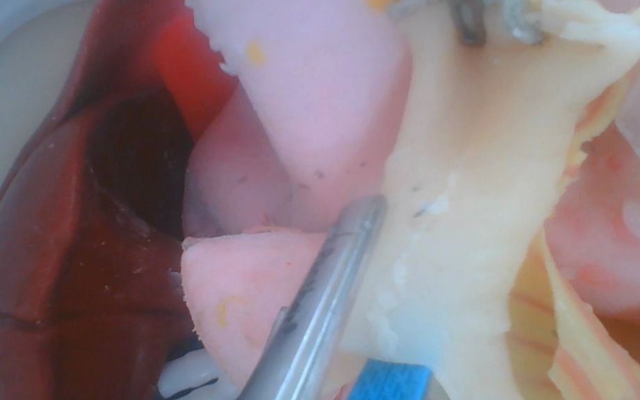 腹腔镜训练-吻合器的使用(硅胶模型)