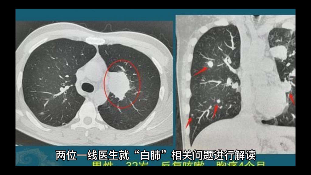 重症白肺死亡率40%以上,专家:新冠造成白肺的概率不是很高
