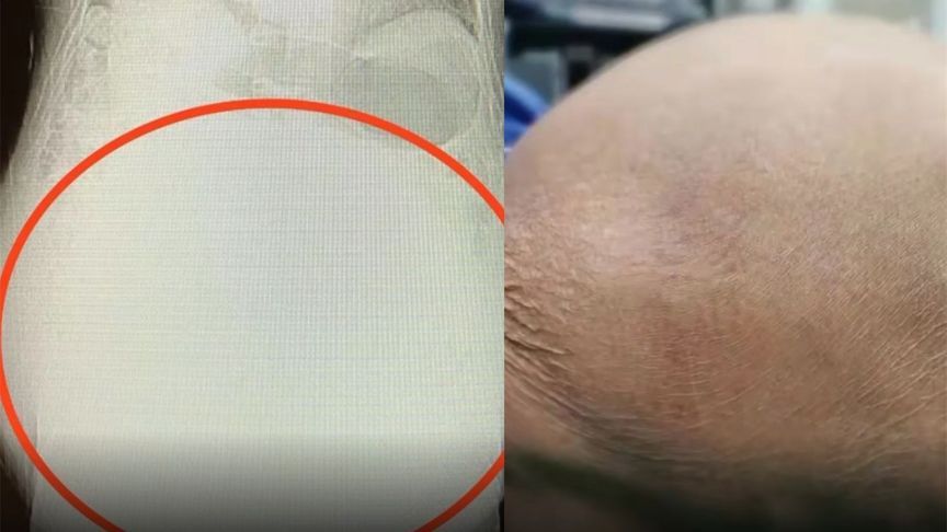 八旬老人长了30斤重肿瘤,东莞医生抽出1万多毫升组织液