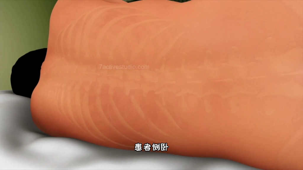 刀尖上跳舞,手术麻醉-硬膜外麻醉过程,3D演示。