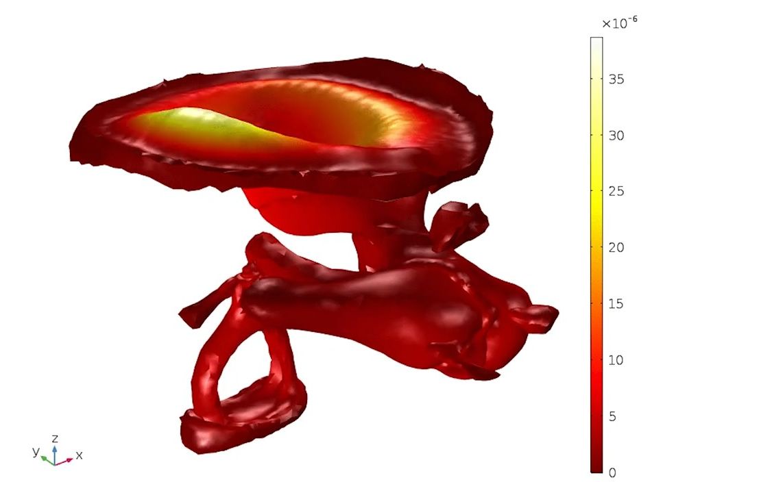 【Simpleware】 在 200 Hz 时正常人类中耳模型的振动模式