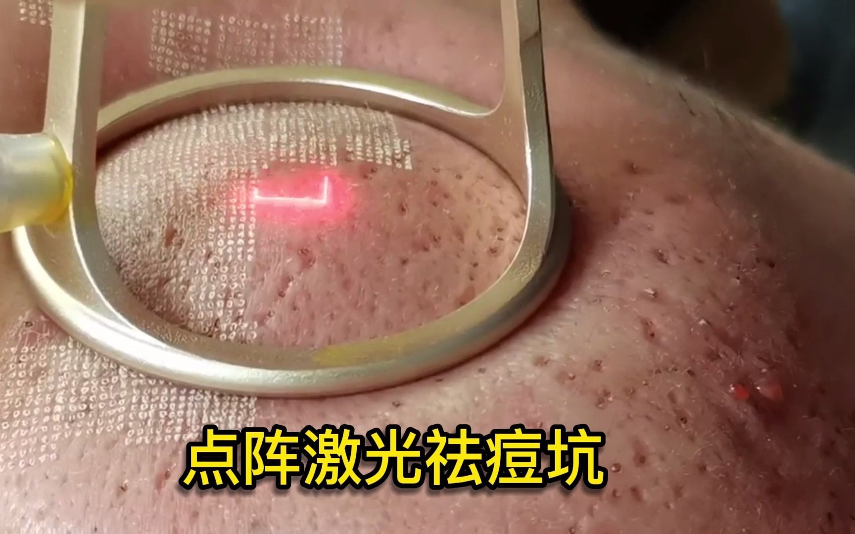 波波哥|点阵激光祛痘视频全过程