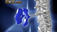 济南骨科医院培训资料,经皮椎体成形术