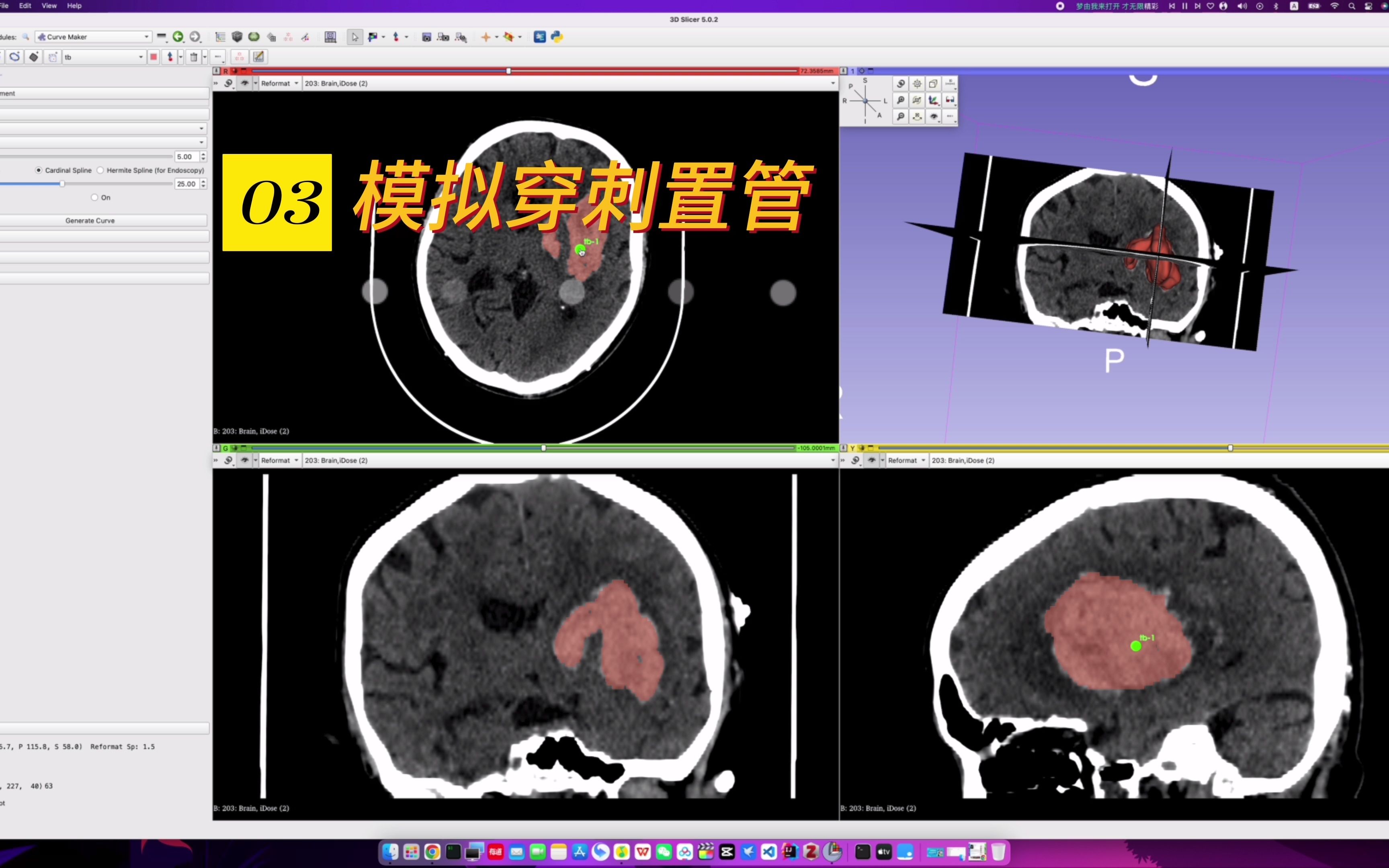 脑出血微创穿刺置管外引流手术,老手术,新看法