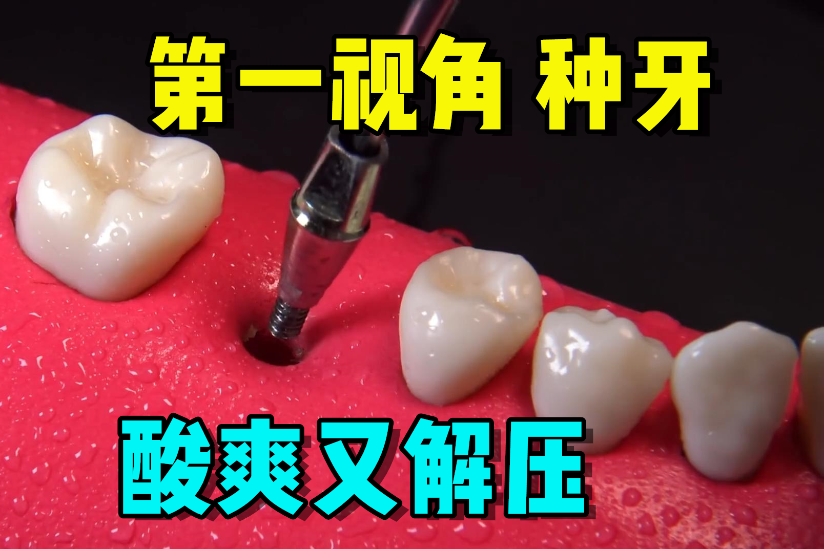 .骨头,花2万块在嘴里种了一颗牙,看完感觉一切都值了