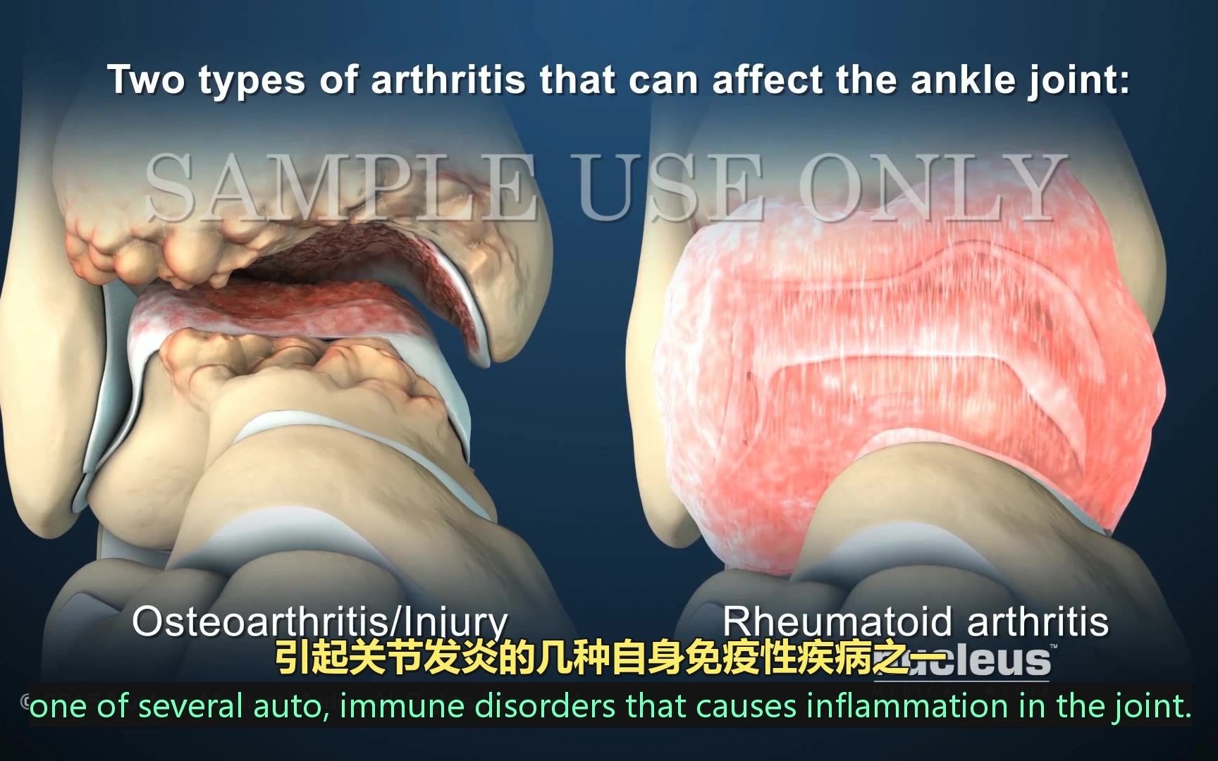 【3D医学动画】踝关节置换术(中英双字幕)
