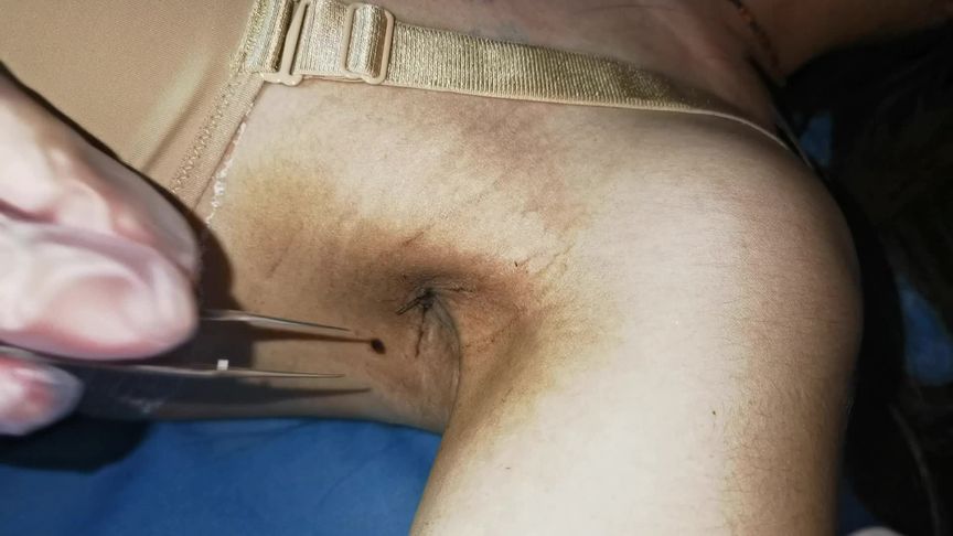 假体隆胸拆线实录-左腋窝无痕美容缝合#假体丰胸 #假体隆胸#丰胸