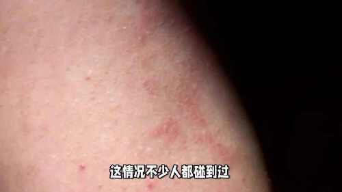 皮肤突发红痒疙瘩别乱挠!3步急救法快速止痒消疹