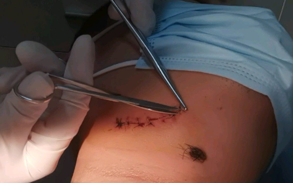 手术伤口缝合的线是怎么拆除的!