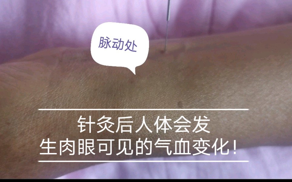针灸后人体会发生肉眼可见的气血变化!