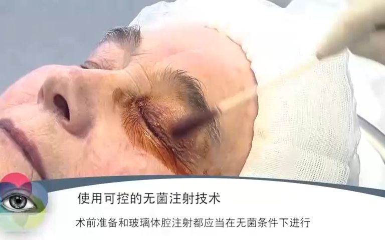 玻璃体药物注射(傲迪适)