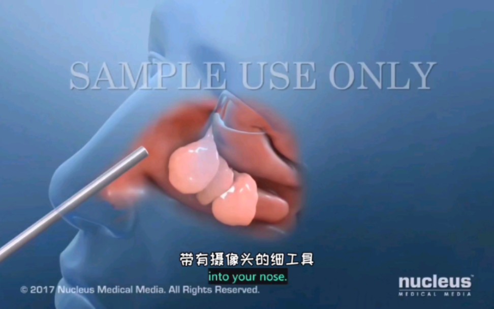 鼻息肉手术切除过程,3D演示。