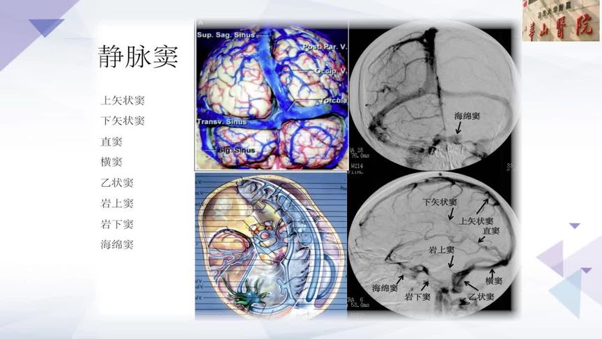 脑静脉系统血管解剖与造影解读