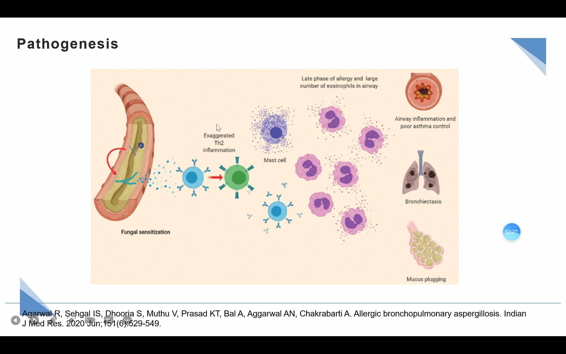 变应性支气管肺曲霉菌病 ABPA