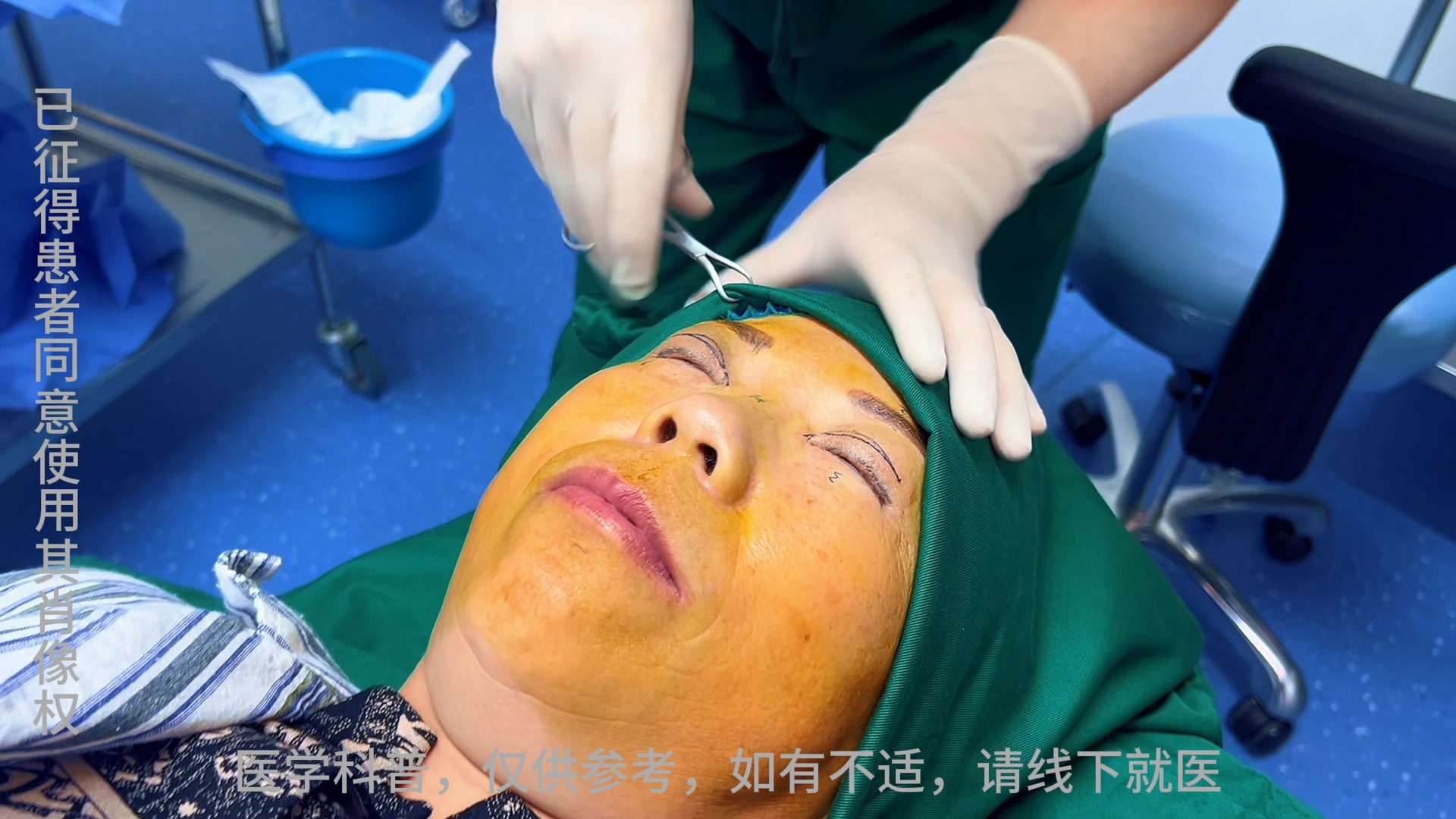 薛院带你沉浸式体验双眼皮手术全过程