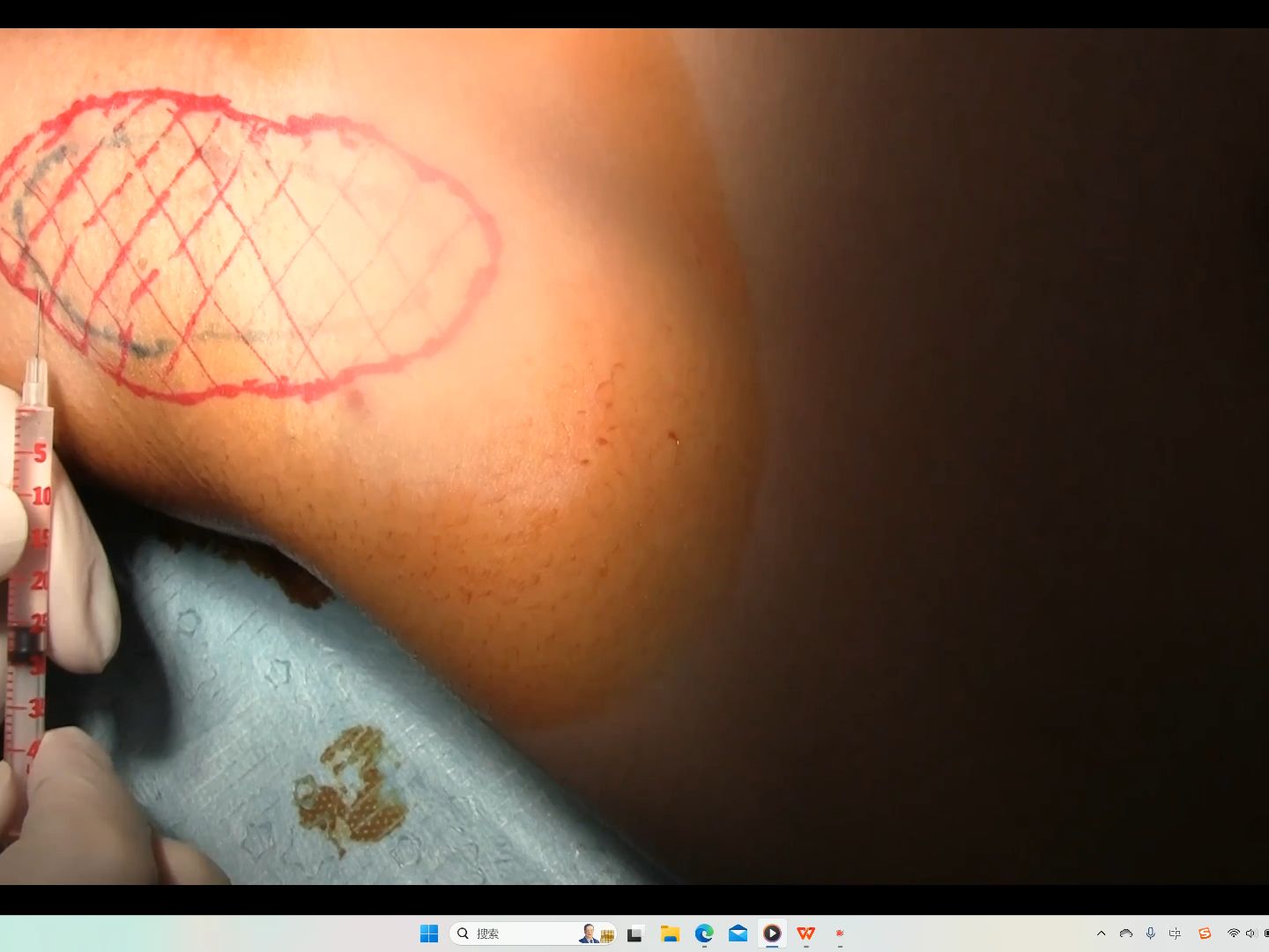 狐臭-注射肉毒素方法治疗手术视频 学习使用