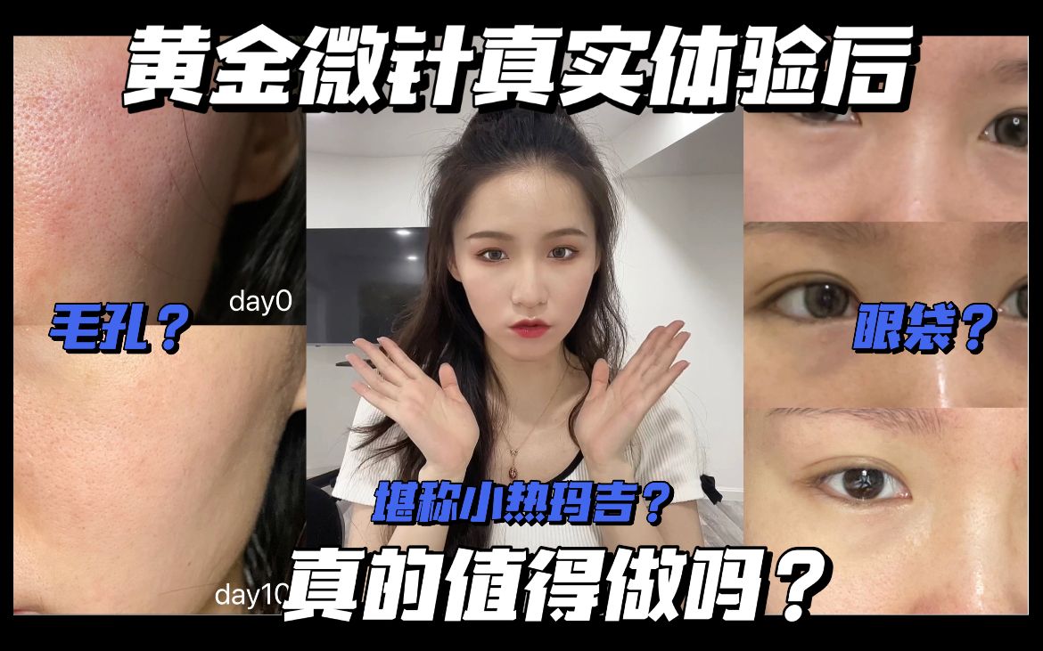 最近风很大的黄金微针到底值不值得做?比普通微针强很多?一键磨平...