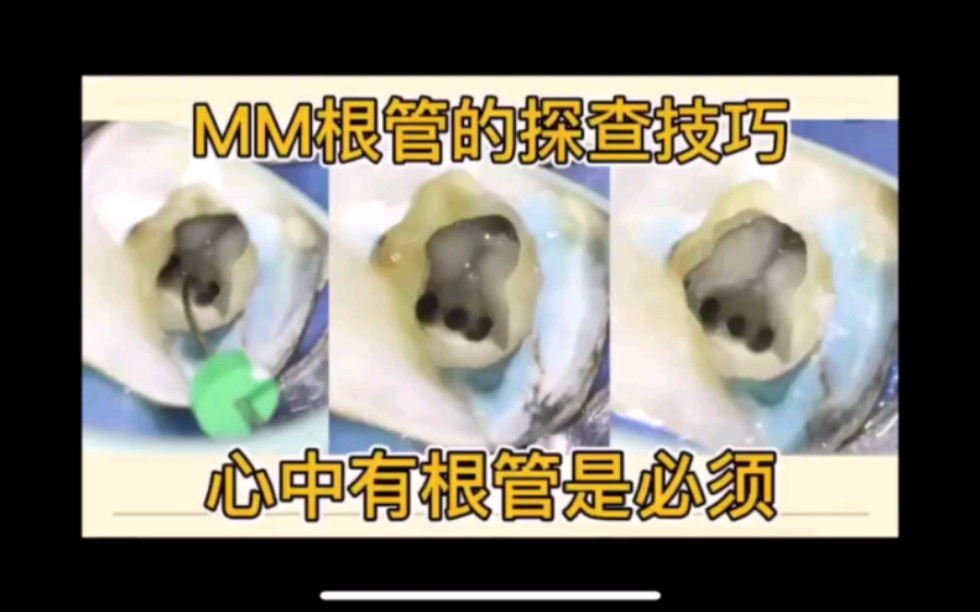 杨丽丽-多根管探查技巧