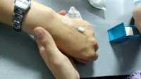 留置针贴膜的撕除