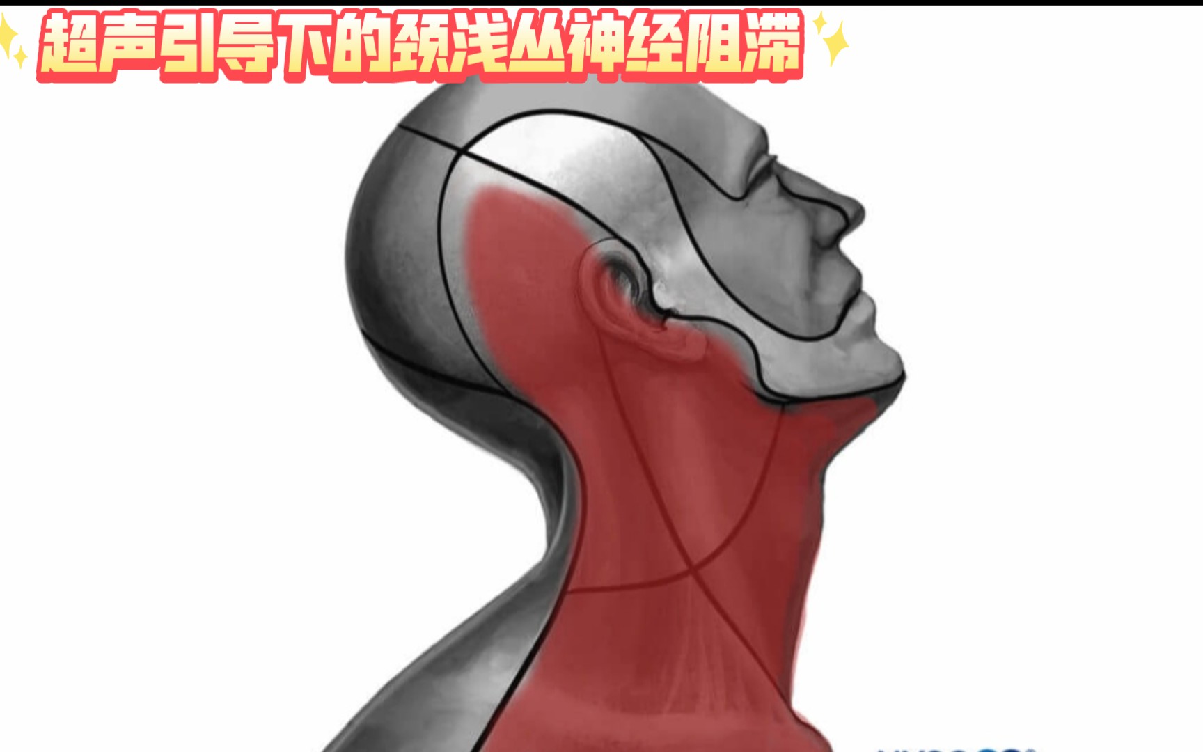 进阶版:超声引导下的颈浅丛神经阻滞图谱