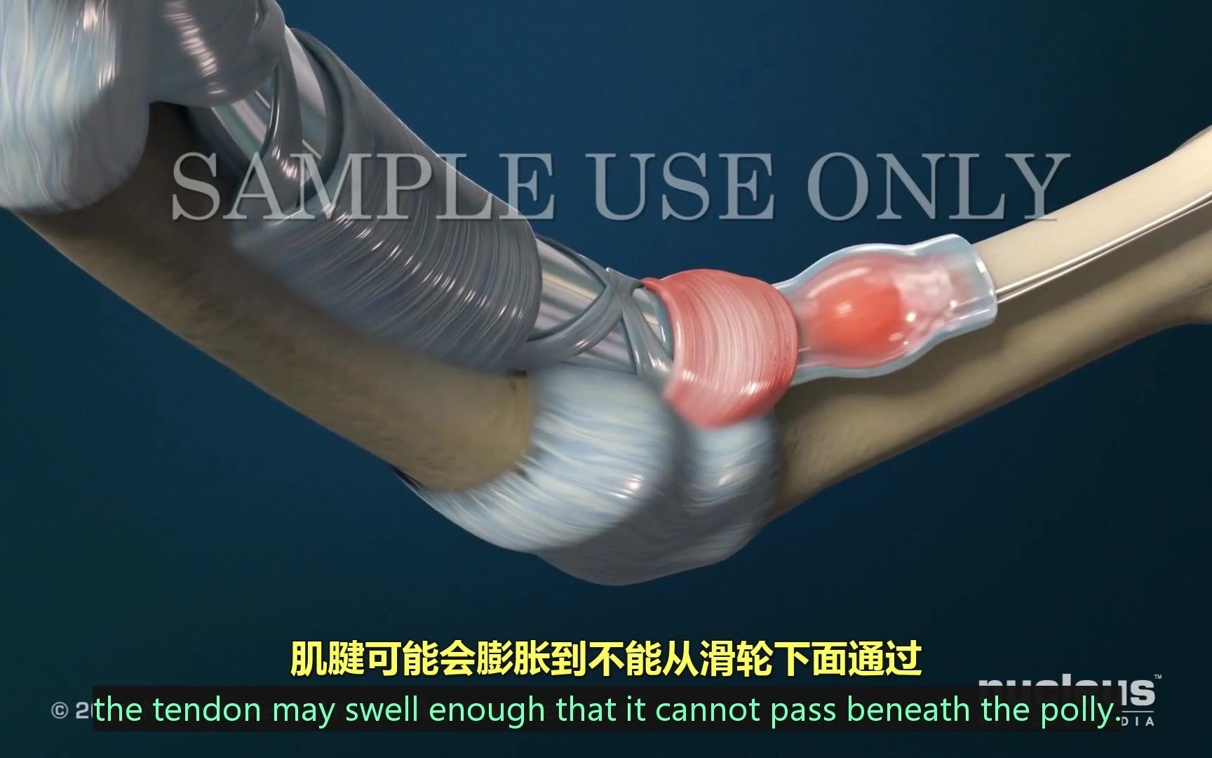 【3D医学动画】一名患者得了腱鞘炎,这是他手指发生的变化